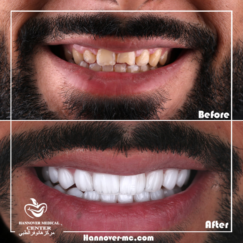 How can I fix my teeth and smile? - Hannover Medical Center Sharjah