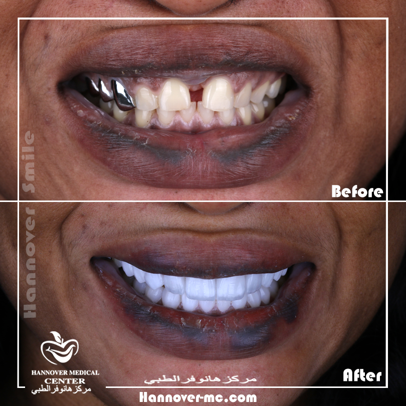 Misalignment of teeth - Hannover Medical Center Sharjah