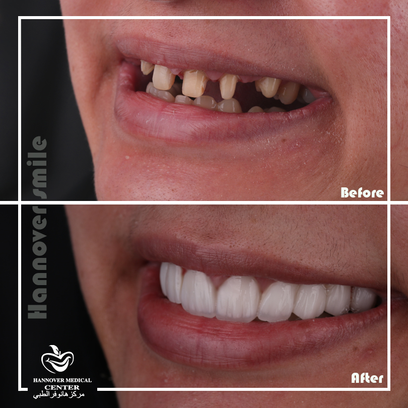 Shortened crowns - Hannover Medical Center Sharjah
