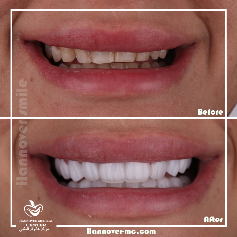 What is a single fake tooth called? - Hannover Medical Center Sharjah