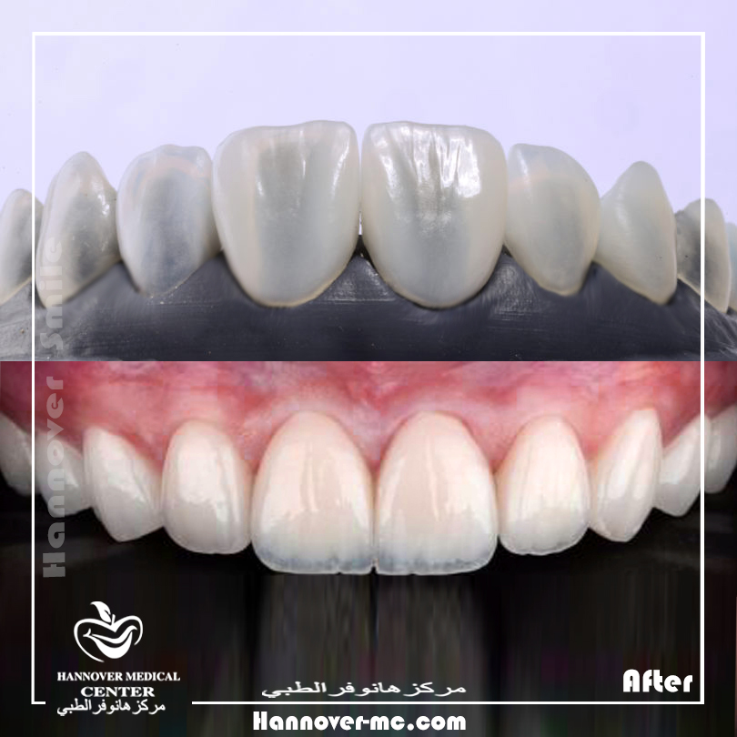 veneers installation Sharjah - Hannover Medical Center Sharjah