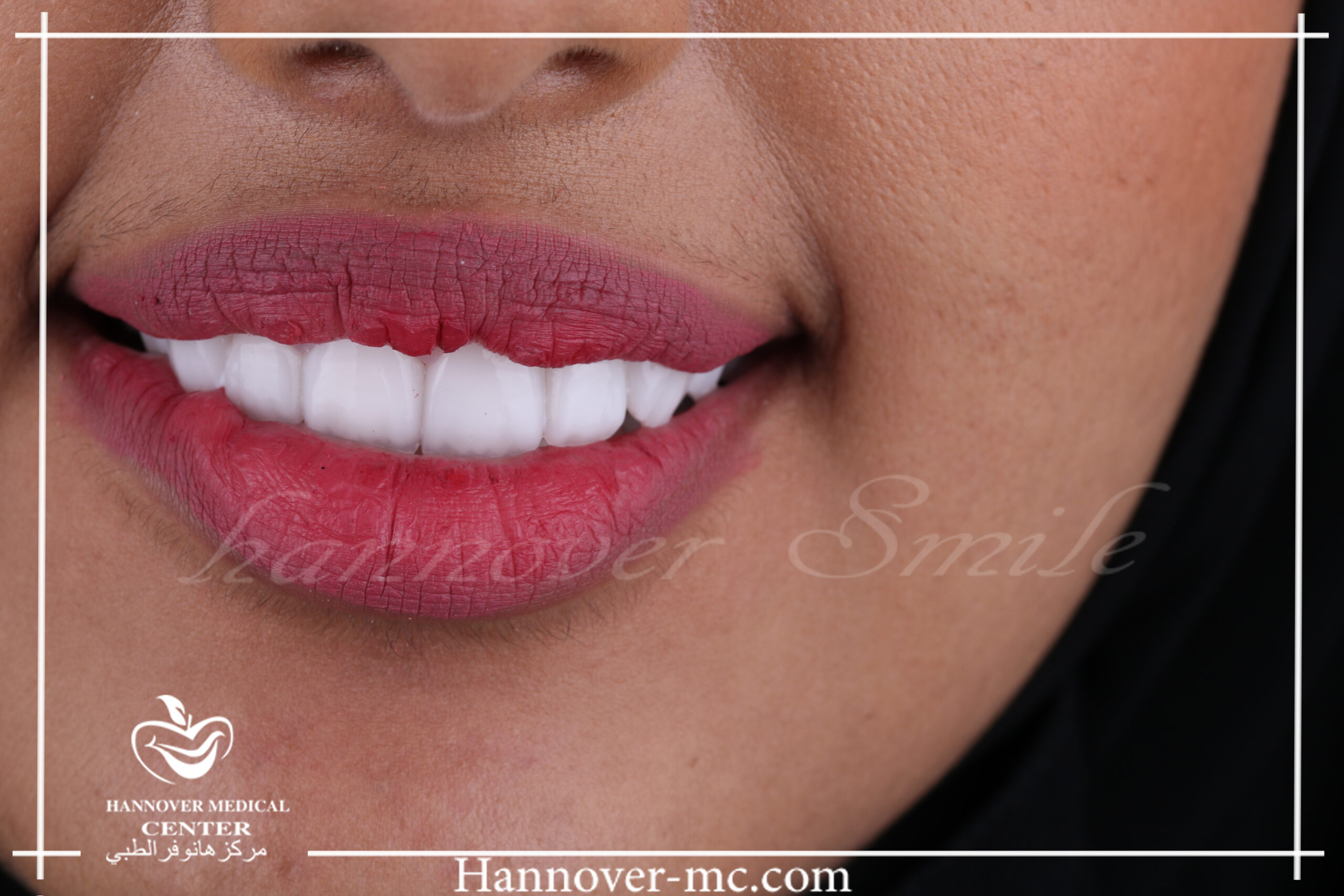 What is the difference between veneers and eMax? - Hannover Medical ...