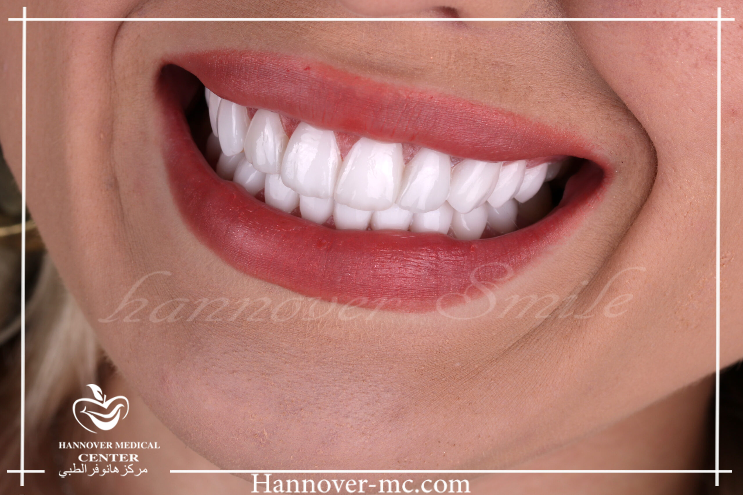 Replace Your Missing Teeth - Full Mouth Dental Veneers - Hannover ...
