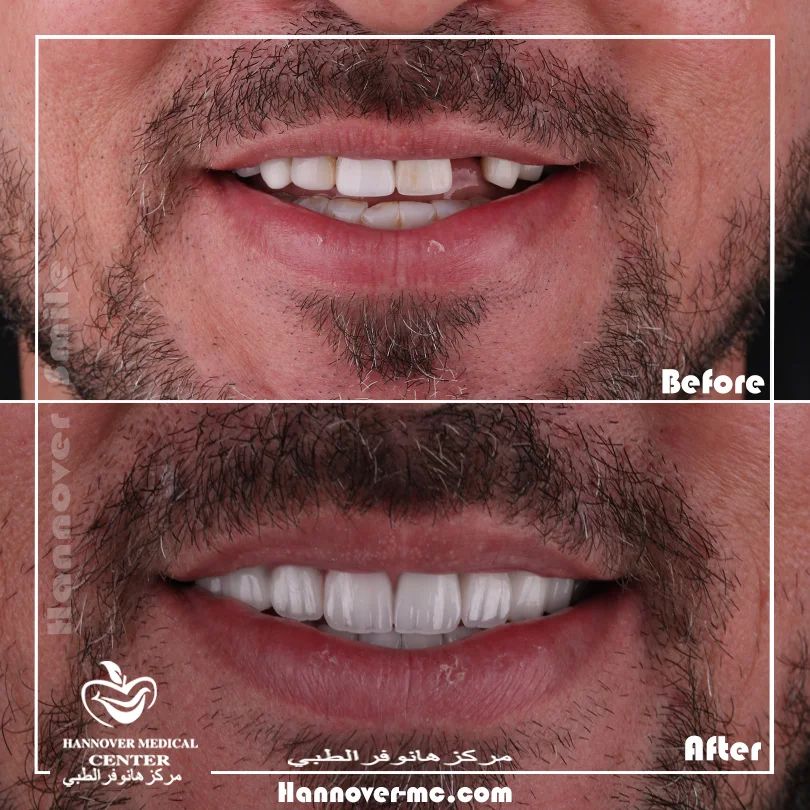 HOW PAINFUL IS A ROOT CANAL TREATMENT? - Hannover Medical Center Sharjah